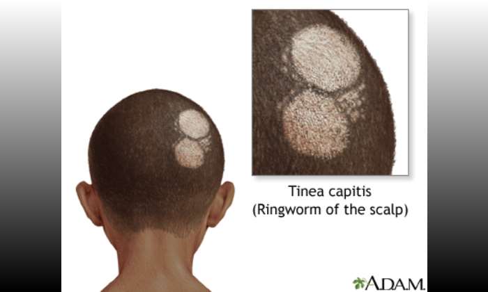 Tinea Corporis Scalp