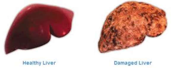 Early Symptoms Of Liver Damage You Should Watch Out For
