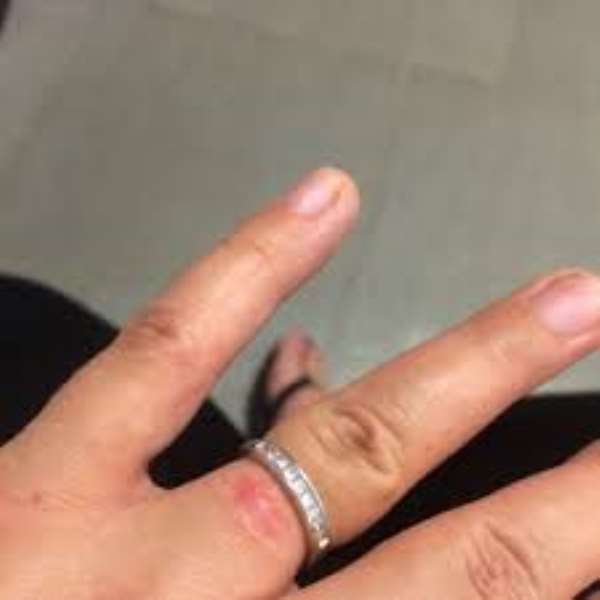 Get Rid Of Wedding Ring Rash With These Tips