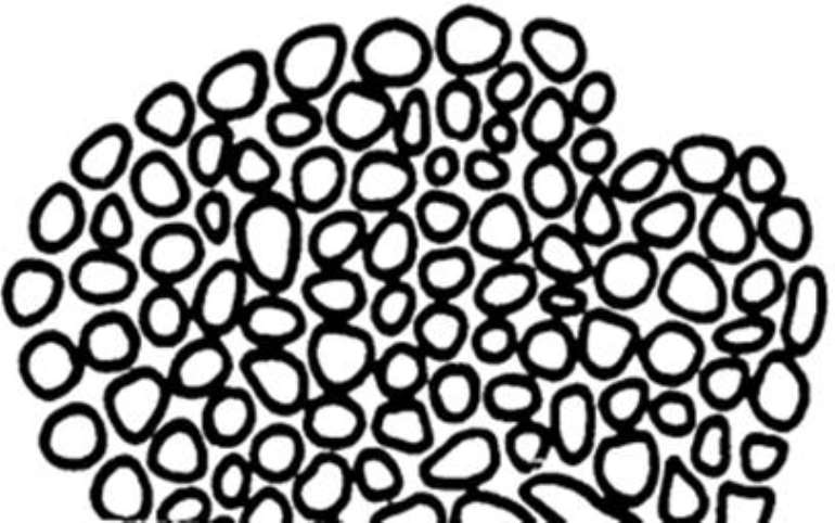 Gleason Score: Understanding Your Prostate Pathology Report