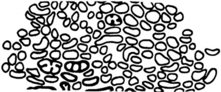 Gleason Score: Understanding Your Prostate Pathology Report