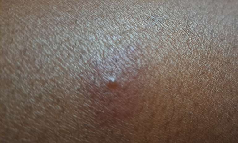 Strange biting insects invade Dawhenya North