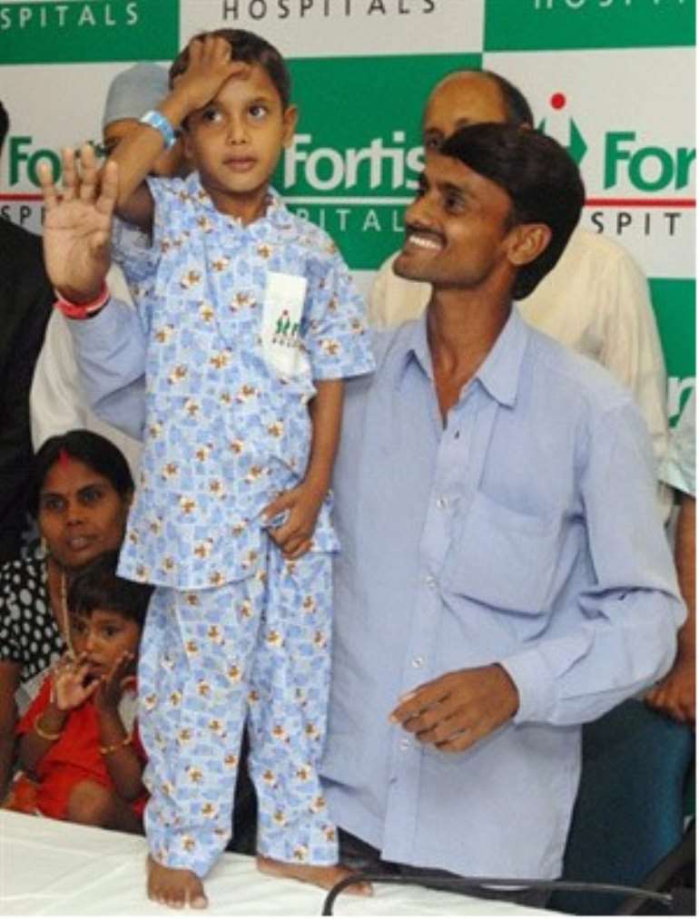 UNUSUAL BIRTH: AN INDIAN BOY WITH EIGHT LIMBS HAS UNDERGONE A ...