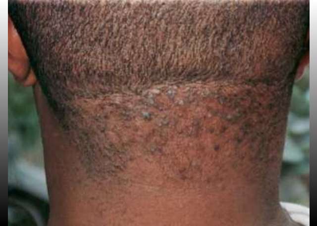 How To Cure Razor Bump At The Back Of The Neck