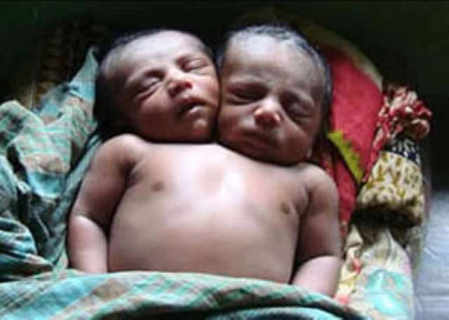 Two Headed Babies Child Born With Two Heads In Syrian City Of Idlib