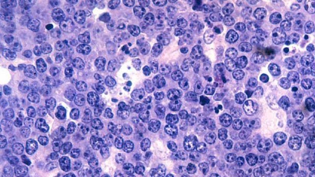 Everything you need to know about Lymphoma