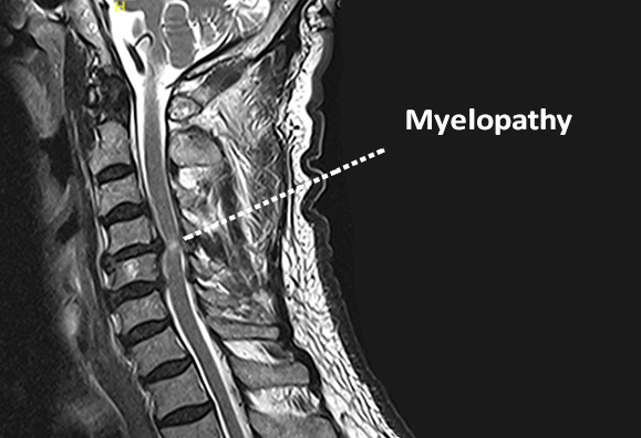 Understanding Cervical Myelopathy: A Neurosurgeon's Insight
