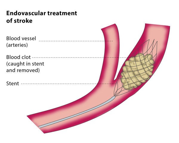 Understanding Endovascular Procedures - A common man’s Guide