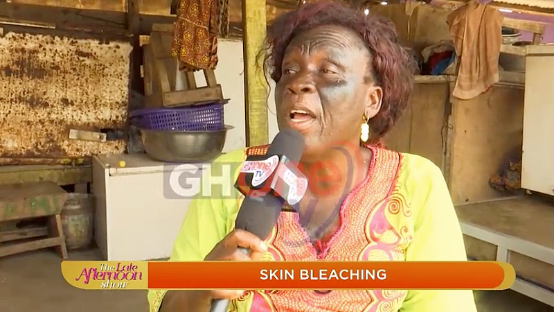 I Went Blind For Bleaching My Skin - Woman Shares Scary Consequences Of ...