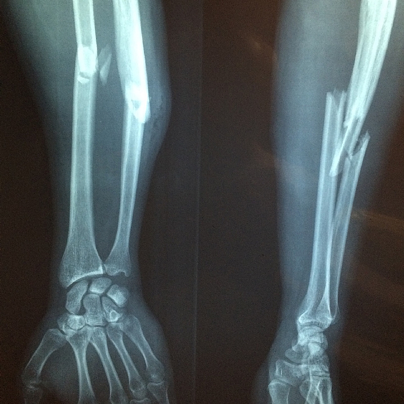 Why Bonesetters Should Prioritize X-Rays Before and After Treatment