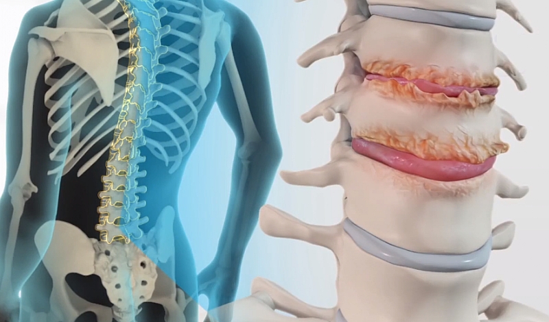 Understanding Spondylosis