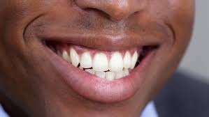 3 Trusted Home Remedies For A Whiter Teeth