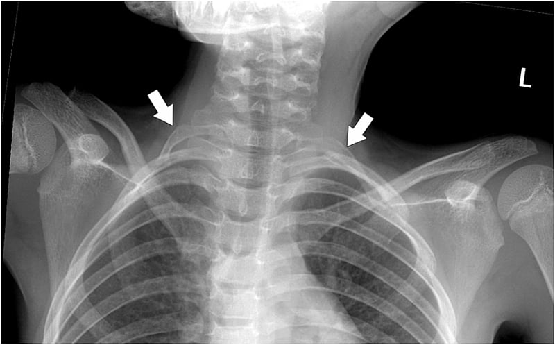 Understanding Cervical Ribs Or Extra Ribs