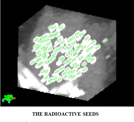 Temporary Seed Implant With High Dose Rate Brachytherapy For Ghanaian Men