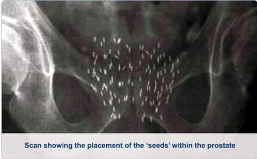 Permanent Seed Brachytherapy For Ghanaian Men