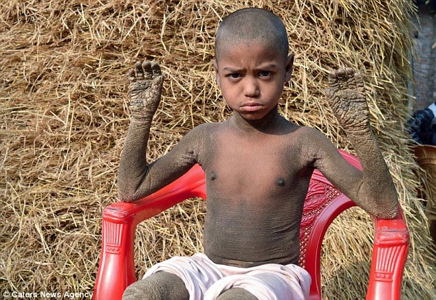 Meet The Eight-Year Old Boy Who Is Turning Into Stone