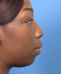 Do You Have Neck Fat? Here's How To Get Rid Of It