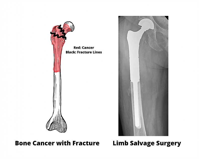 A rare case of limb saving surgery on a septuagenarian at Apollo Cancer ...