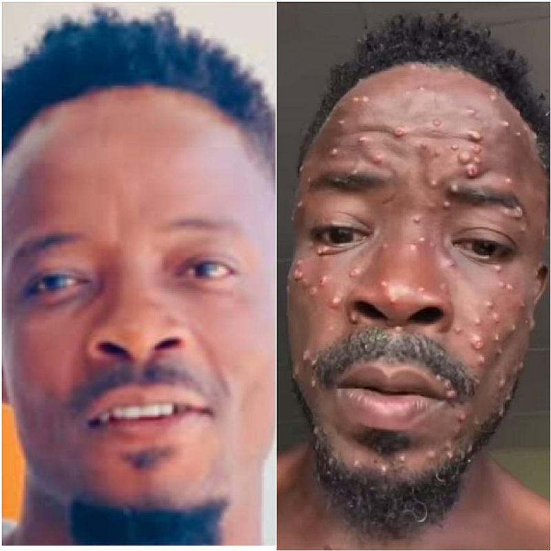 Liberian Actor Jabateh diagnosed with Mpox virus