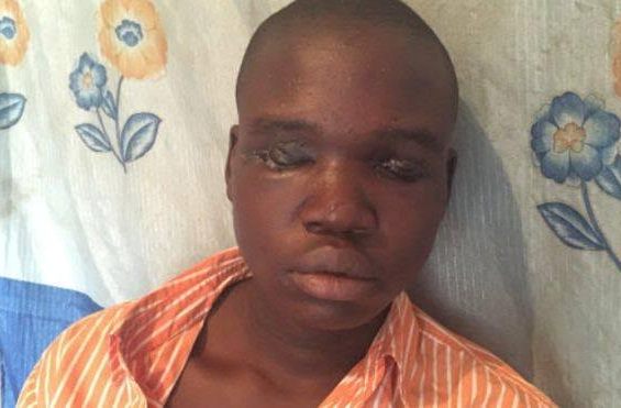 Boy Had His Eyes Plucked Out By His Friends