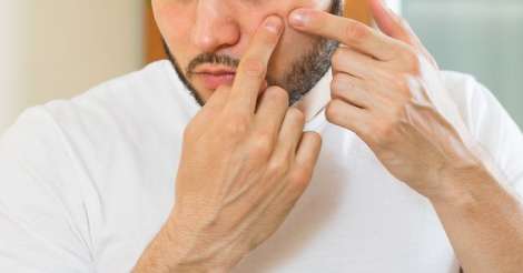 This Explosive Blackhead Cluster Means Byebye To Pimples