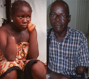 Amputees' Life. After Sierra Leone's 11 years Civil War