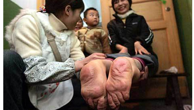 Meet Woman Born With Backwards Feet Who Lives Normal Life