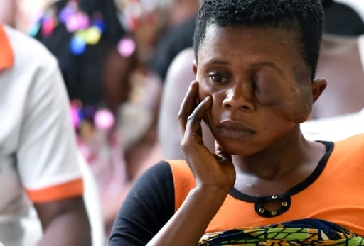 Hope for noma disease victims left without faces in I.Coast
