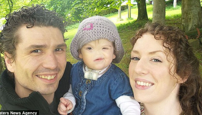 Meet Cheerful 17-Months-Old Baby Girl Born Without A Nose