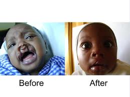 Cleft patients receive free surgical care