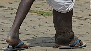 Five cases of elephantiasis seen in Dormaa Central Municipality