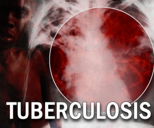 Suspicion for TB cases still low-Dr Bonsu