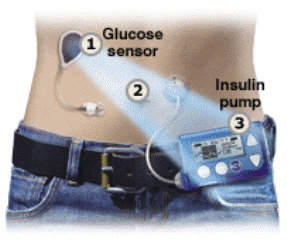 Artificial pancreas hope for children with diabetes