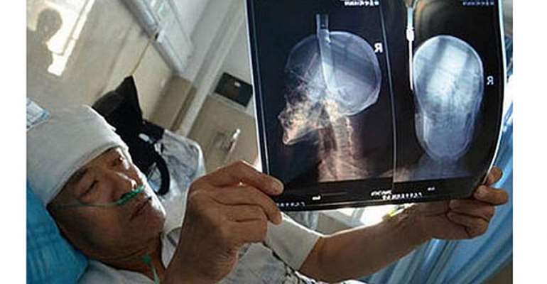 This Man Survived a Knife Through His Brain