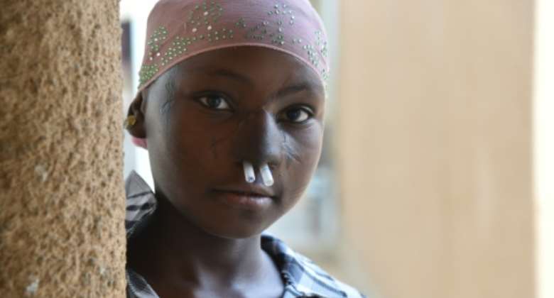 Malnutrition brings a terrible disease to children in Niger