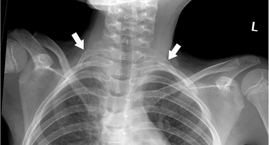 Understanding Cervical Ribs or Extra Ribs