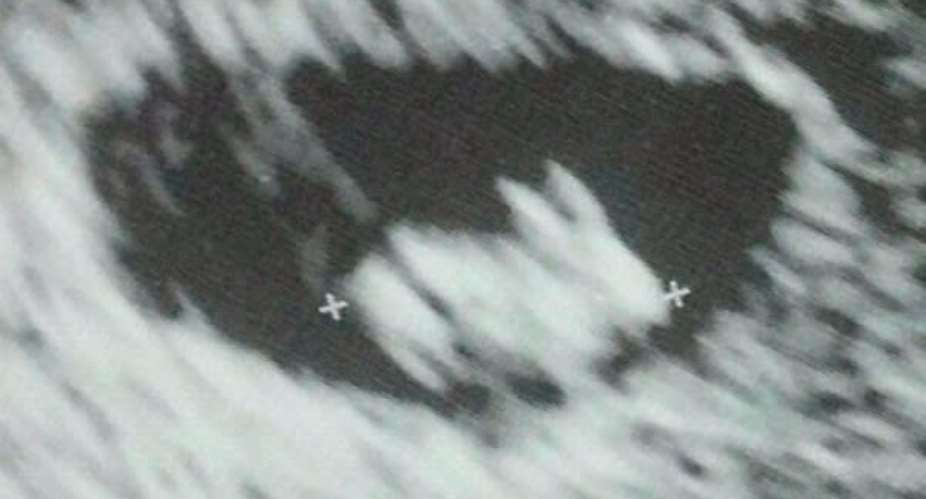 Pregnant woman shares picture of ultrasound scan that looks like rabbit