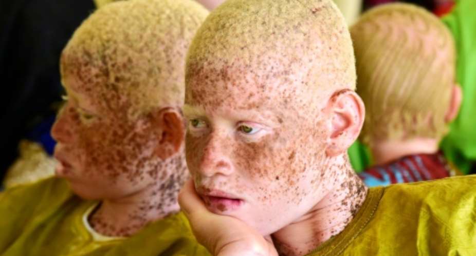 Pandemic hits cancer care for DR Congo's albinos