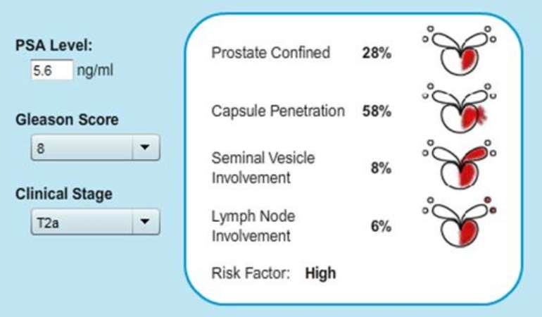 Gleason Score: Understanding Your Prostate Pathology Report