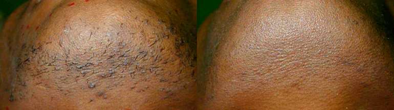 10 tips to prevent ingrown hair