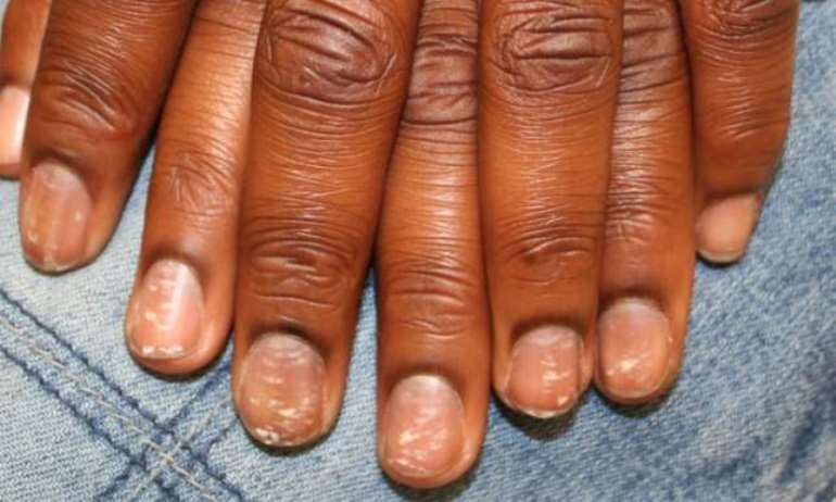 Health Alert! 6 Diseases You Are Likely To Pick From The Salon